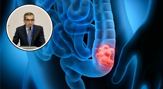 Tumore Al Colon Casi Raddoppiati Nei Giovani Loncologo Aumenta La Forma Sporadica Ecco I 5