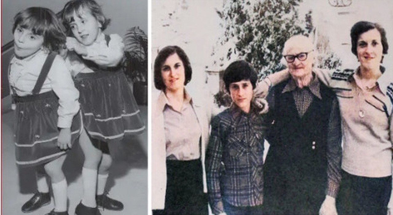 Gemelle siamesi, 60 anni fa il primo intervento di separazione in ...