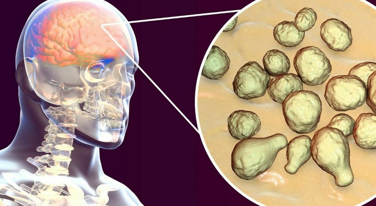 Understanding the Severity and Transmission of Bacterial Meningitis