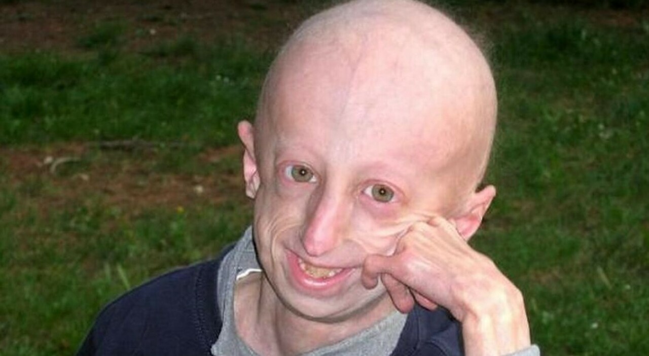The Inspiring Journey of Sammy Basso: Overcoming Progeria