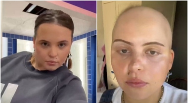 ALOPECIA - Il Messaggero